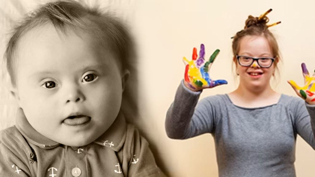 Down Syndrome: ડાઉન સિન્ડ્રોમ એ બાળકોને થતી ગંભીર બીમારી છે, ચાલો તેના ...