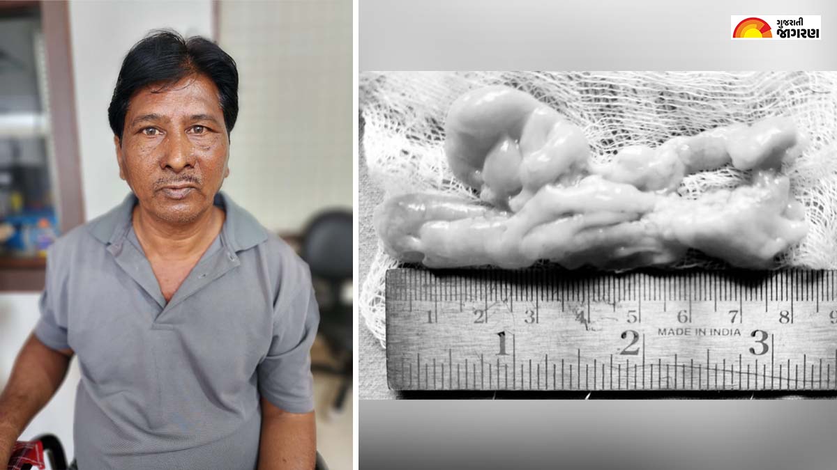 Rakot: દર્દીના નાકમાં ઊંડે ફસાયેલો 8 cmનો મસો કોઈપણ ચેકા કે ટાંકા વિના ...