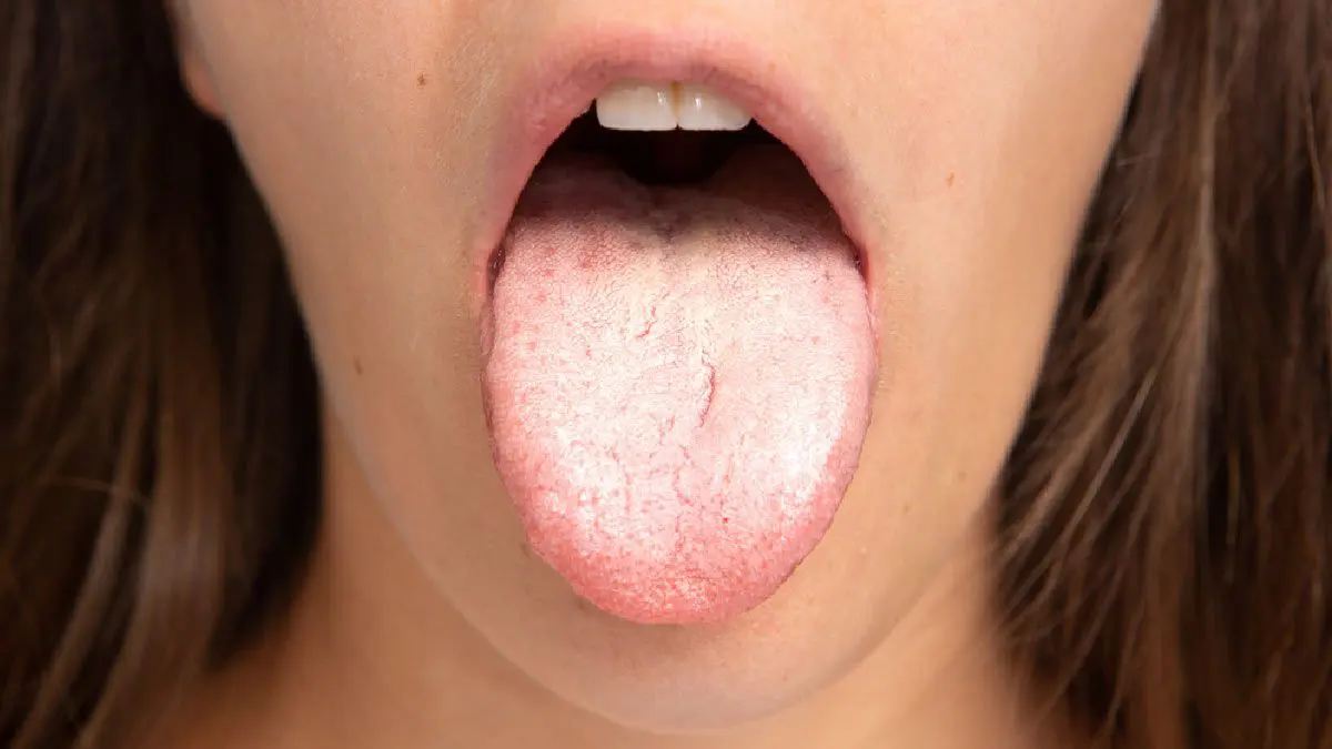 White Tongue Meaning: શું જીભનું સફેદ થવું કોઈ બિમારીની નિશાની છે ...